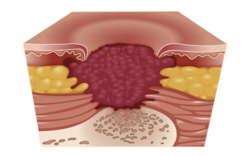 Skin Ulcer(Bedsore) Stages: How It Ruins Your Skin - Voibon Blog
